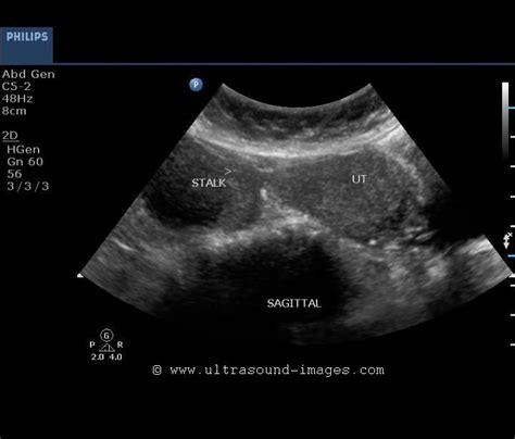 Cochinblogs Pedunculated Fibroid Of Uterus