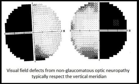 My Patient Has Optic Nerve Pallor What Do I Do