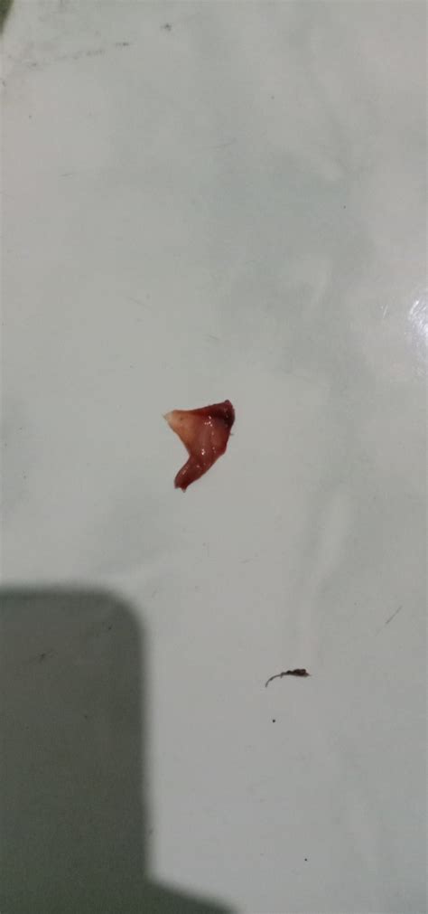Muncul Gumpalan Saat Pipis Hellosehat