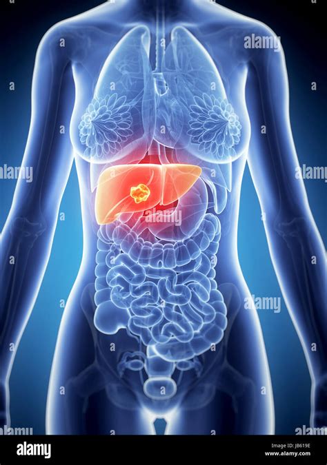 3d Rendered Illustration Of The Female Anatomy Liver Cancer Stock