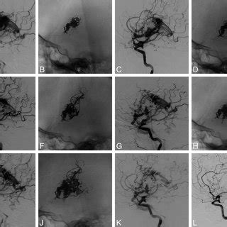 Right Frontal AVM A Right Internal Carotid Angiogram Lateral View