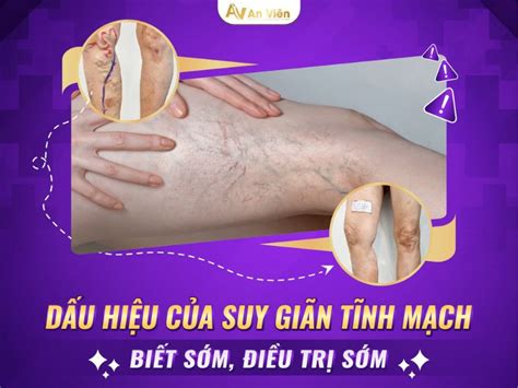 Tránh 3 triệu chứng suy giãn tĩnh mạch chi dưới và viêm khớp