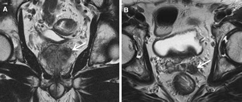 Prostatitis Mimicking Transition Zone Cancer And Seminal Vesicle