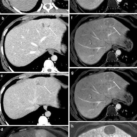 Contrast Enhanced Ultrasound Appearance Of Hcc In A 41 Yo Female