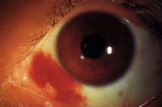 SOAP Vaccines Eyes Flashcards Quizlet
