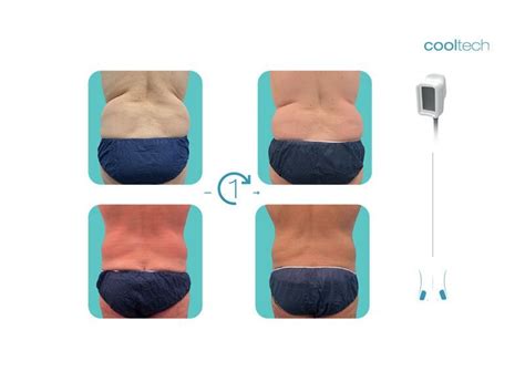 Non Invasive Fat Reduction Fat Freezing LunaC Aesthetics