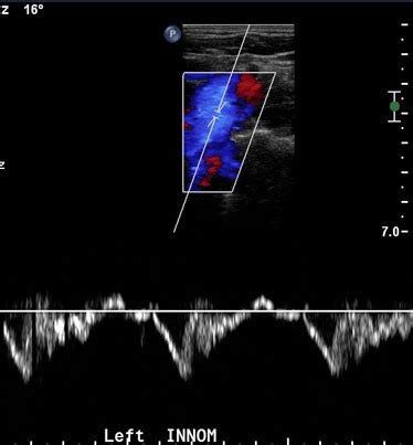 Us Left Innominate Vein Color And Spectral Tracings Demonstrate Normal
