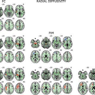 Effects Of Gender Identity And Sex On Regional AD See Schema In Figure Download Scientific
