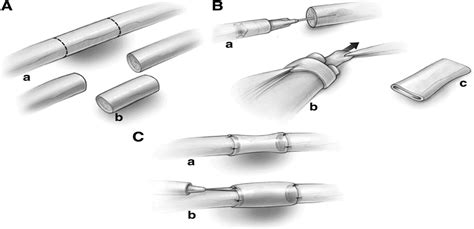 Peripheral Nerve Defect Repair With Epineural Tubes Supporte