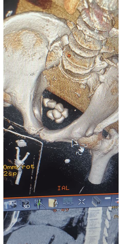 Did Someone Say Bladder Stones Rradiology
