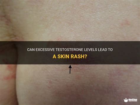 Can Excessive Testosterone Levels Lead To A Skin Rash Medshun
