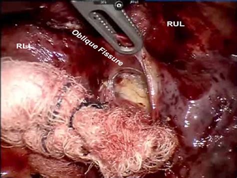 The Technique Of Robotic Anatomic Pulmonary Segmentectomy I Right