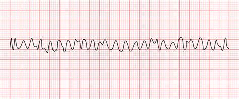 Ventricular Fibrillation Causes And Treatment Acls Algorithm