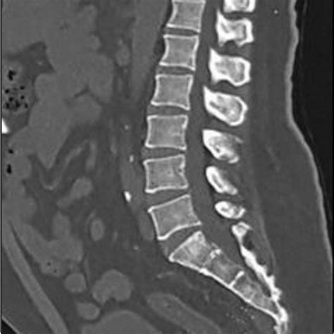 Sagittal Computed Tomography Scan Image Of Lumbosacral Spine Download