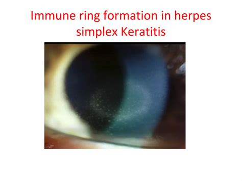 Allergy And Hypersensitivity Perrenial Conjunctivitis Vernal Conjunctivitis Gpc And
