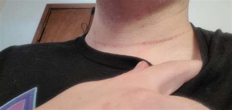 Ring Around Neck After Wearing Latex Today Is This Something I Should