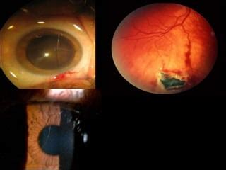 Siderosis Andchalcosis And Iofb Pptx