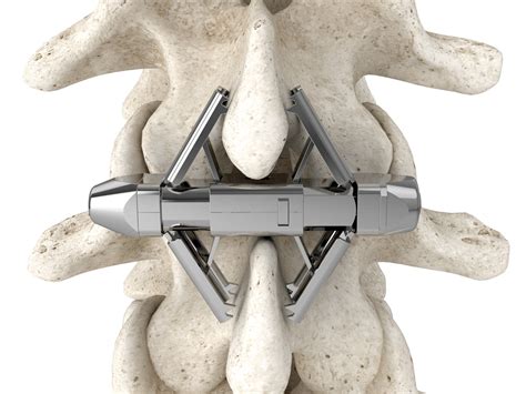 Percutaneous Interspinous Stabilization And Fusion System Biomedica