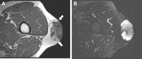 Magnetic Resonance Imaging Showed A Well Circumscribed Multilocular