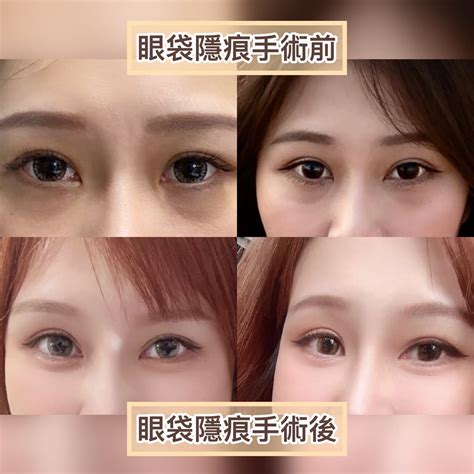 眼袋雙眼皮口內取脂微整一次做！ 女孩板 Dcard