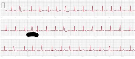 Interpolated Pvc And Trigeminy R Pvcs