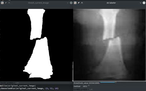 Python Image Threshold Algorithms To Use On An X Ray Image And Detect Bones Stack Overflow