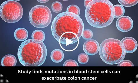 Study Finds Mutations In Blood Stem Cells Can Exacerbate Colon Cancer