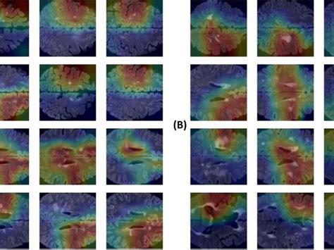 differentiation between multiple sclerosis and neuromyelitis optica