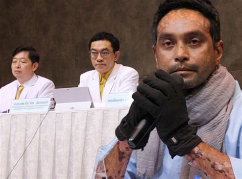 แพทย์แถลงอาการ วินัย ไกรบุตร ป่วยโรคตุ่มน้ำพอง เกิดจากอะไร วิธีรักษา