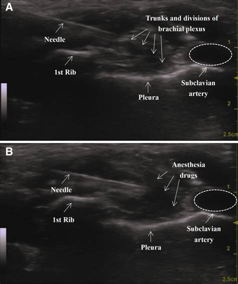Ultrasound Image Of The Supraclavicular Approach Before A And After