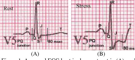 Figure 1 From Cad Detection Using Neural Network Fusion Of The 12 Lead