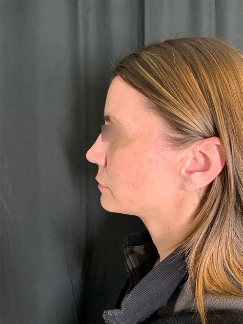 Before And After Facial Fat Transfer Kirkland Dr Tseng
