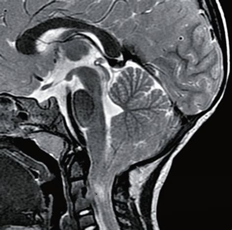 Chiari 1 Malformation