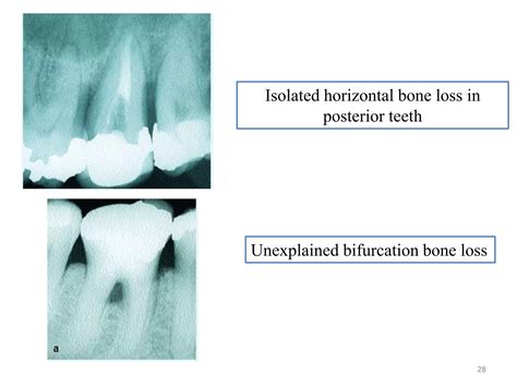 Vertical Root Fracture And Its Management Pptx Dental Health Diseases And Conditions