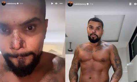 Naldo Benny entenda como o ácido hialurônico pode causar necrose