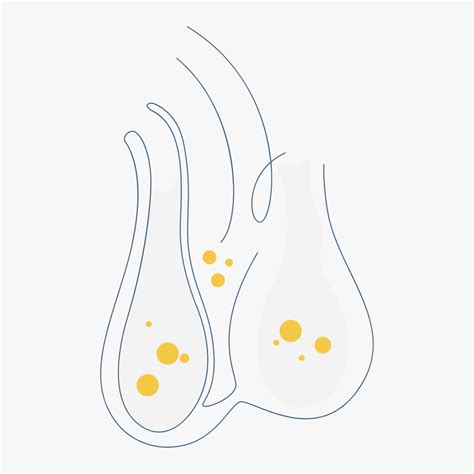 Scrotal Cyst