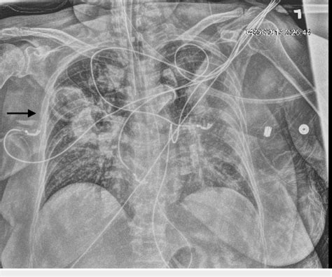 Chest X Ray Showing Right Upper Lobe Cavitary Lesion With A Surrounding