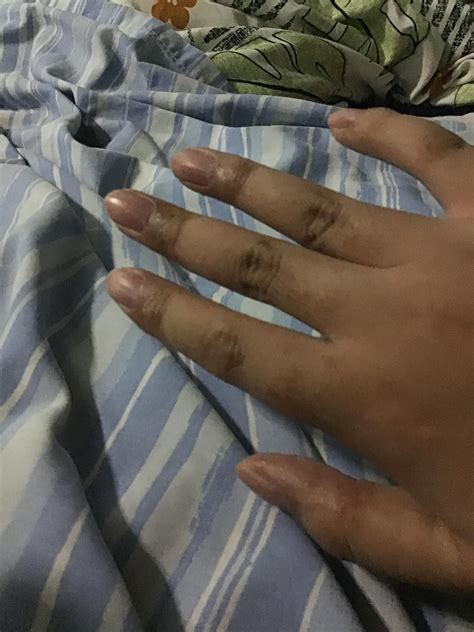 Recently Have Dyshidrosis Is This Fungal Infection On My Nails You