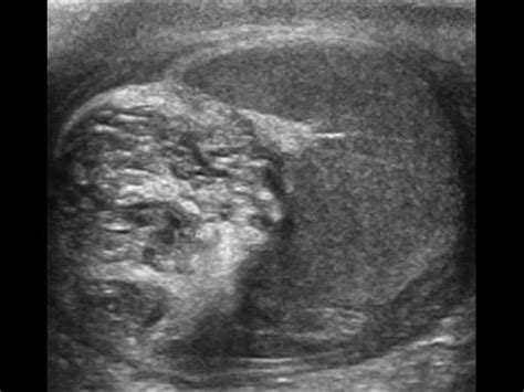 Urinary Tract And Male Reproductive System 23 Scrotum Case 237