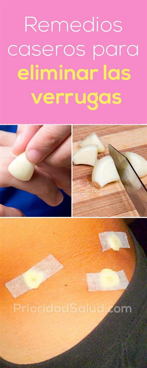 Remedios caseros para eliminar las verrugas de forma natural y rápida