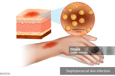 Staphylococcal Skin Infection Or Staph Infection Superimposed Bacterial
