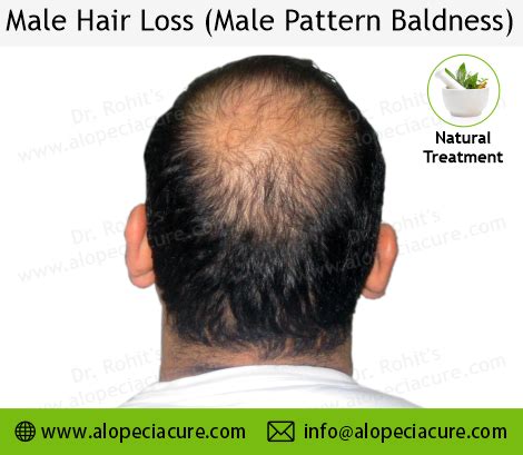 Diffuse Patterned Alopecia DPA Diffuse Unpatterned Alopecia DUPA