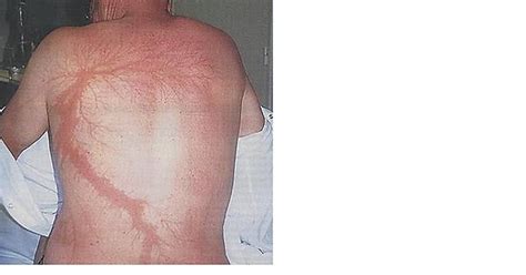 The Results Of Lightning Striking A Man Imgur