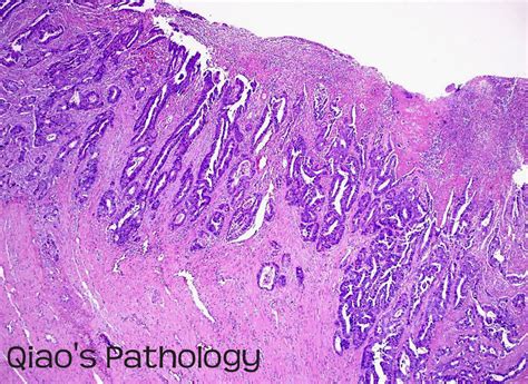 Qiaos Pathology Adenocarcinoma Of The Colon With Surface Flickr
