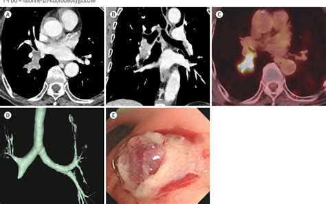 Figure 5 From Ct Findings Of Central Airway Lesions Causing Airway