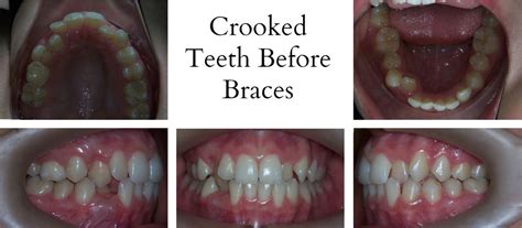Braces On Ugly Teeth At Beth Anker Blog