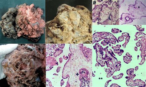 La Imagen Macroscópica Muestra Placenta Con Vellosidades Hidrópicas De
