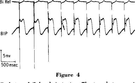 Figure 4 From Slow Ventricular Activation In Acute Myocardial