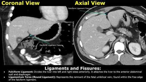 Liver Ct Anatomy Surfaces Lobes Ligaments And Fissures Porta Hepatis