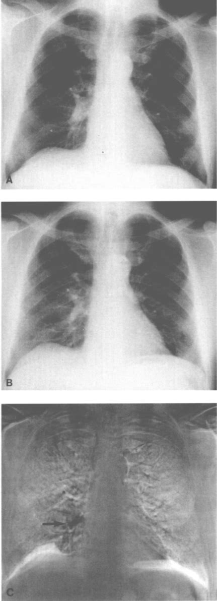 Scheme Of Chest Temporal Subtraction By Automated Initial Image